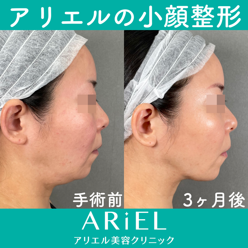 【症例写真】ほほ/あご下 脂肪吸引 No.6022｜埼玉県さいたま市大宮区の美容外科・美容皮膚科アリエル美容クリニック